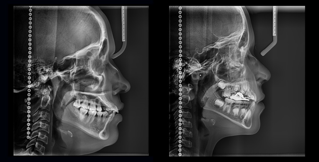 CEFALOMETRIA LATERAL - KD Digital