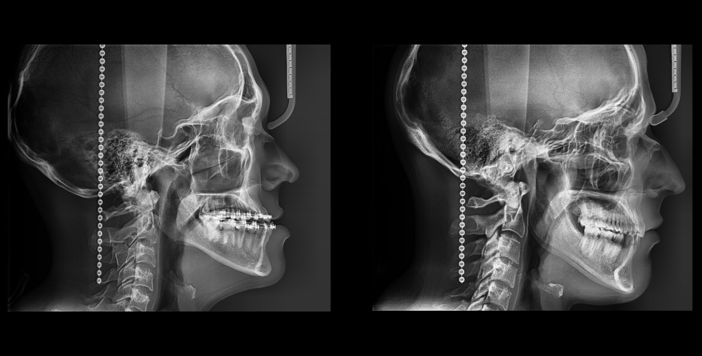 CEFALOMETRIA FULL LATERAL - KD Digital